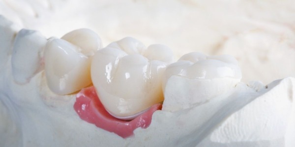 Are Your Dental Crowns Too Old? 6 Signs to Look For